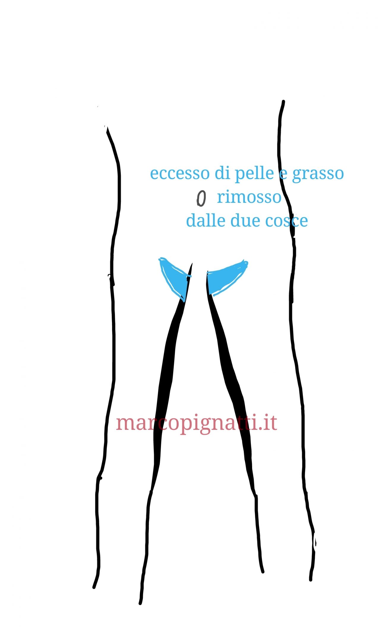 Lifting cosce - Prof. Pignatti Marco